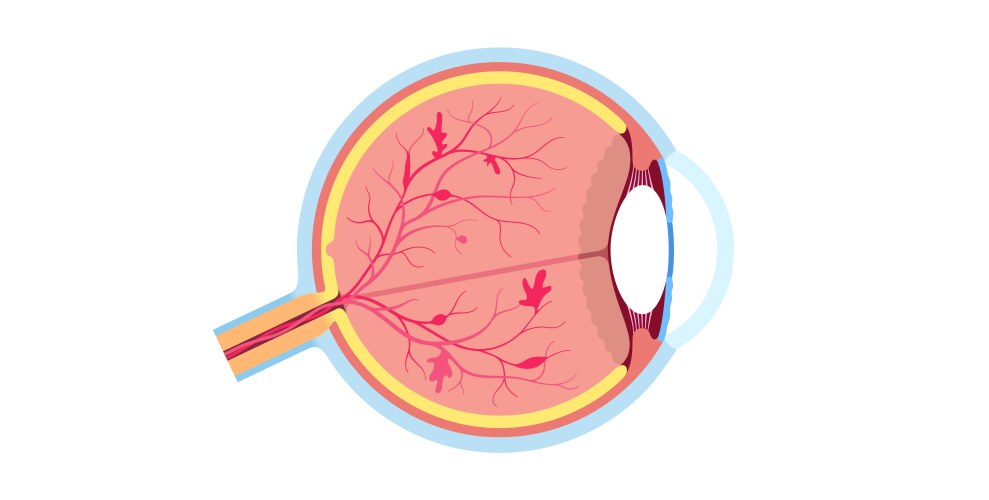 Diabetes related retinopathy Royalty Free Vector Image