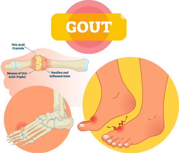 Gout arthritis infographic Royalty Free Vector Image