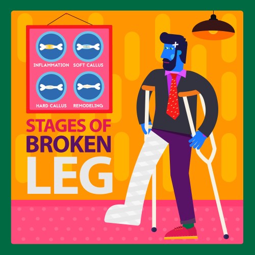 1 stage of healing bone fracture formation Vector Image