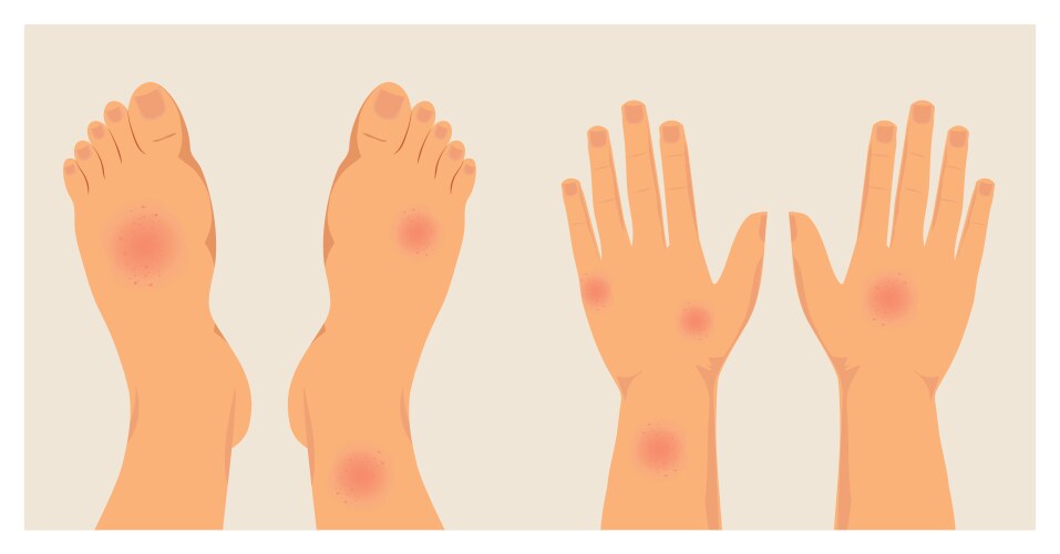 Skin Rash Vector Images (over 5,500)