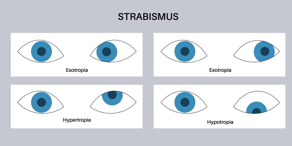 Strabismus eye disease Royalty Free Vector Image