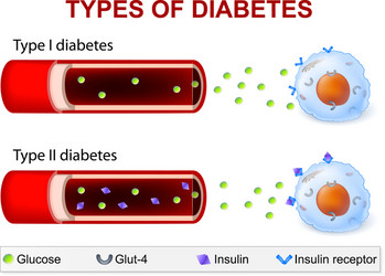 Diabetes mellitus type 1 Royalty Free Vector Image