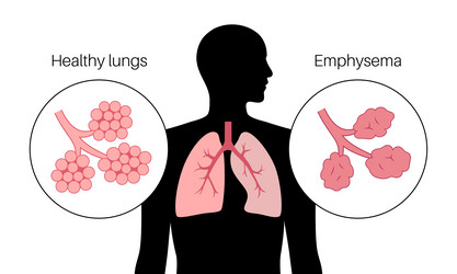 Emphysema anatomical poster Royalty Free Vector Image
