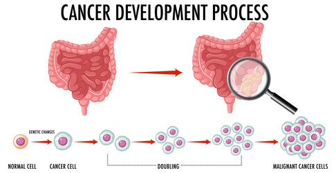 Medical diagram of 2 stages prostate cancer Vector Image