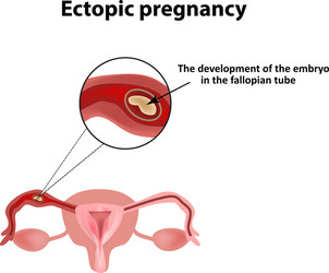 Ectopic pregnancy and normal concept Royalty Free Vector