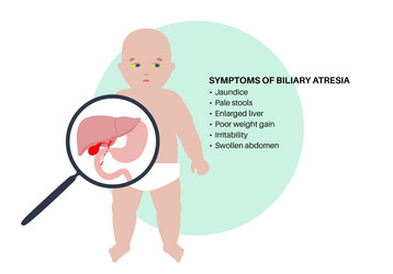 Biliary atresia disease Royalty Free Vector Image