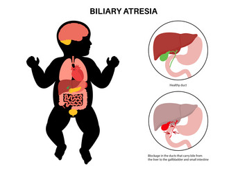 Biliary atresia disease Royalty Free Vector Image