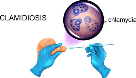 Chlamydia Vector Images (over 180)