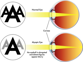 Vision defects visual impairment normal myopia Vector Image