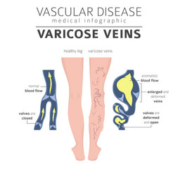 Varicose veins symptoms and preventions poster Vector Image