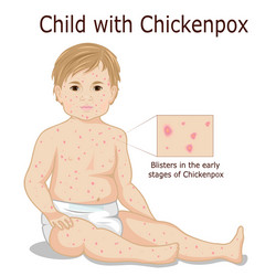 A child with rubella Royalty Free Vector Image