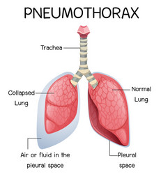 Pneumothorax Vector Images (over 180)