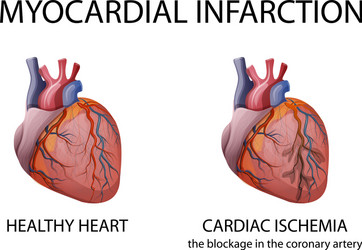 Myocardial infarction Royalty Free Vector Image