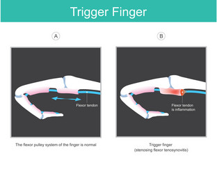 Trigger Finger Vector Images (over 150)