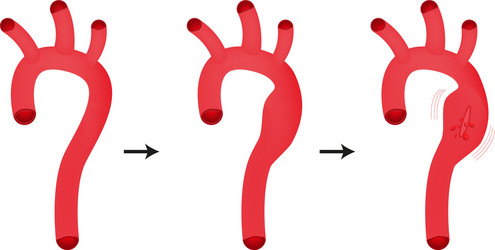 Ruptured aortic aneurysm disease Royalty Free Vector Image