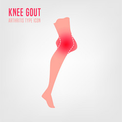Gout arthritis infographic Royalty Free Vector Image