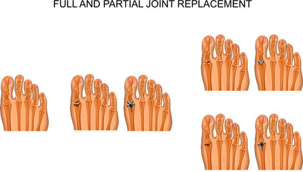 Destruction of the joint big toe Royalty Free Vector Image