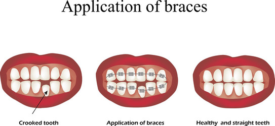 Crooked teeth orthodontics infographics Royalty Free Vector