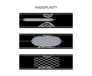 Angioplasty cardiac stent Royalty Free Vector Image