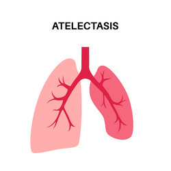 Atelectasis Vector Images (28)