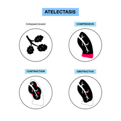 Atelectasis Vector Images (28)