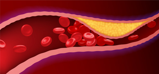 Arteries with clogged fat that causes blood clots Vector Image