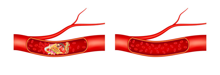 Blood Clotting Vector Images (over 1,500)