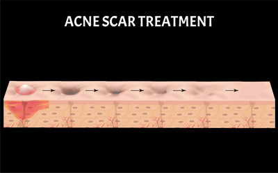 Scars keloid the anatomical structure skin Vector Image