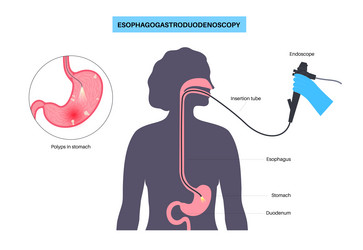 Gastroscopy endoscopy procedure Royalty Free Vector Image