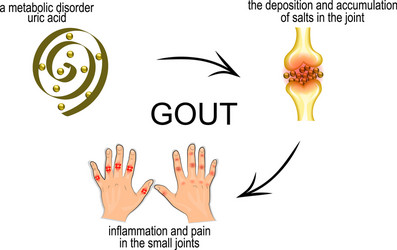 Gout arthritis infographic Royalty Free Vector Image