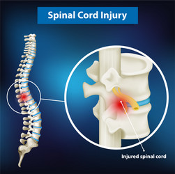 Diagram showing pinched nerve in human Royalty Free Vector