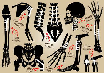 Types of bone fractures medical educational Vector Image