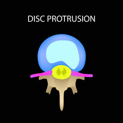 Disc protrusion top view spine infographics Vector Image