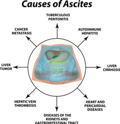 Paracentesis Vector Images (29)