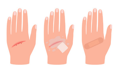 Burn of hand child skin different degree first Vector Image