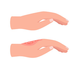 Wound of hand human skin scratch cut injury Vector Image
