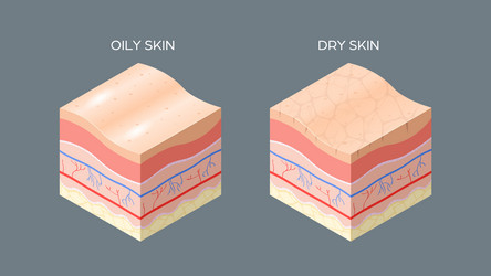 Acne vulgaris or pimple cross-section human Vector Image