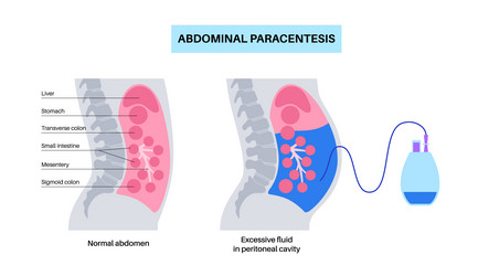 Paracentesis Vector Images (29)