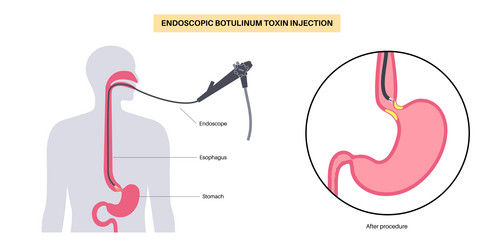 Esophageal botulinum toxin injection Royalty Free Vector