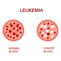 Infographic image leukemia leukaemia disease Vector Image
