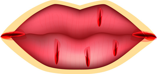 Chapped Lips Cartoon