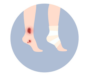 Human leg injury Royalty Free Vector Image - VectorStock