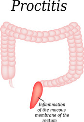 Colon proctitis on a gray Royalty Free Vector Image
