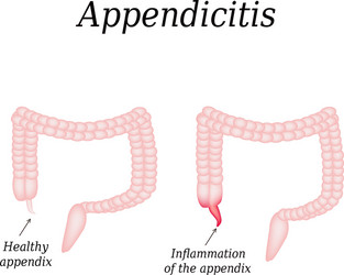 Appendicitis inflammation of the appendix colon Vector Image