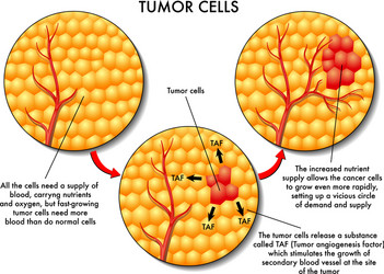 Cancer Metastasis Vector Images (over 400)
