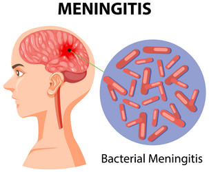 Diagram showing meningitis in human brain Vector Image