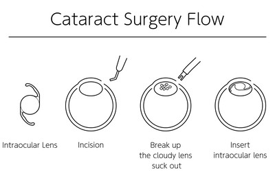 Cataract surgery process line drawing sucking out Vector Image