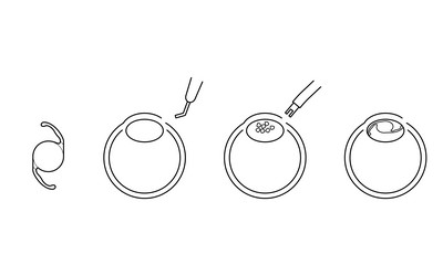Cataract surgery process line drawing making Vector Image
