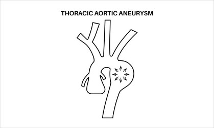 Thoracic aortic aneurysm Royalty Free Vector Image