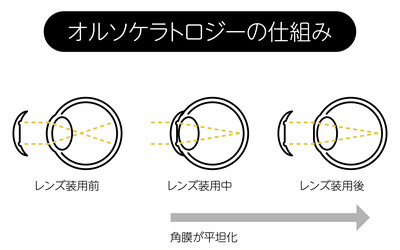 How vision correction lenses and orthokeratology Vector Image